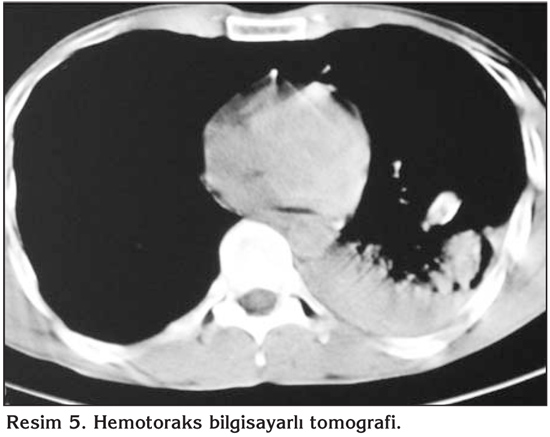 Spontan tansiyon hemopn?motoraks