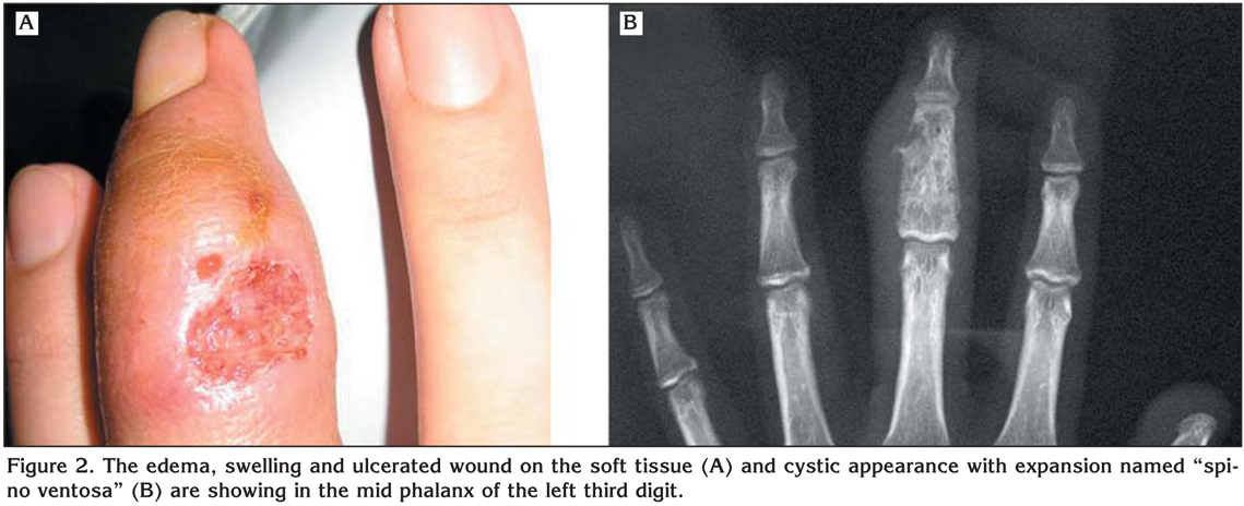 A case with multisystemic involved of Tuberculosis