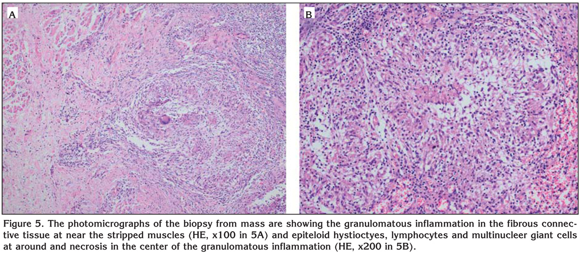 A case with multisystemic involved of Tuberculosis