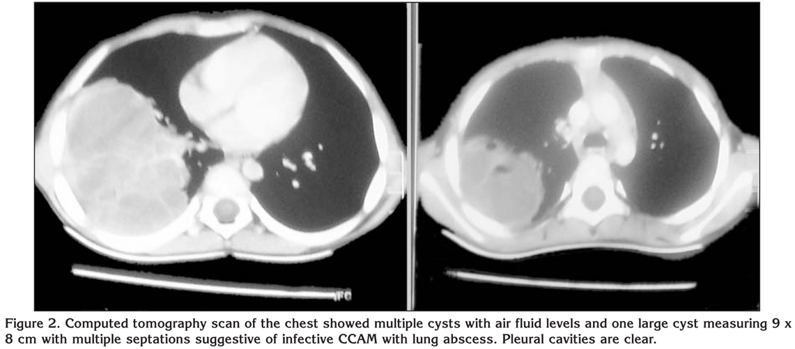 Congenital cystic adenomatoid malformation presenting as lung abscess ...