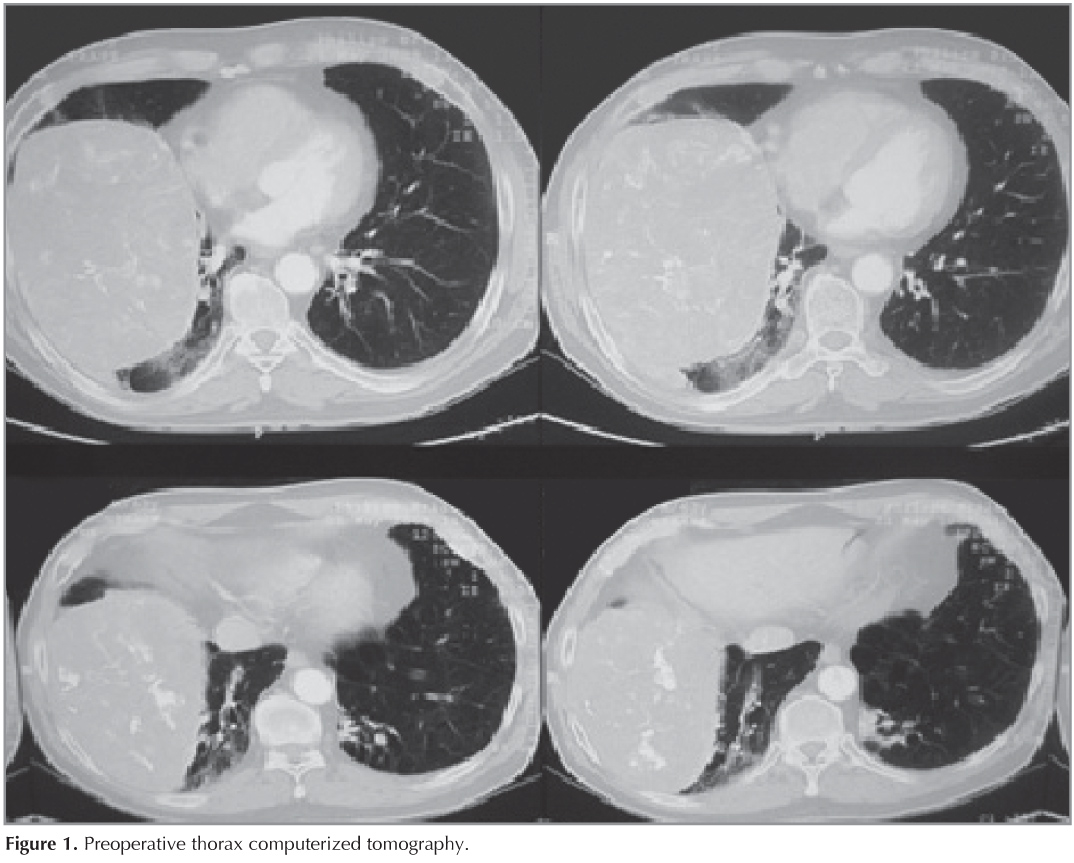 Giant Intrapulmonary Malignant Localized Fibrous Tumor: A Case Presentation