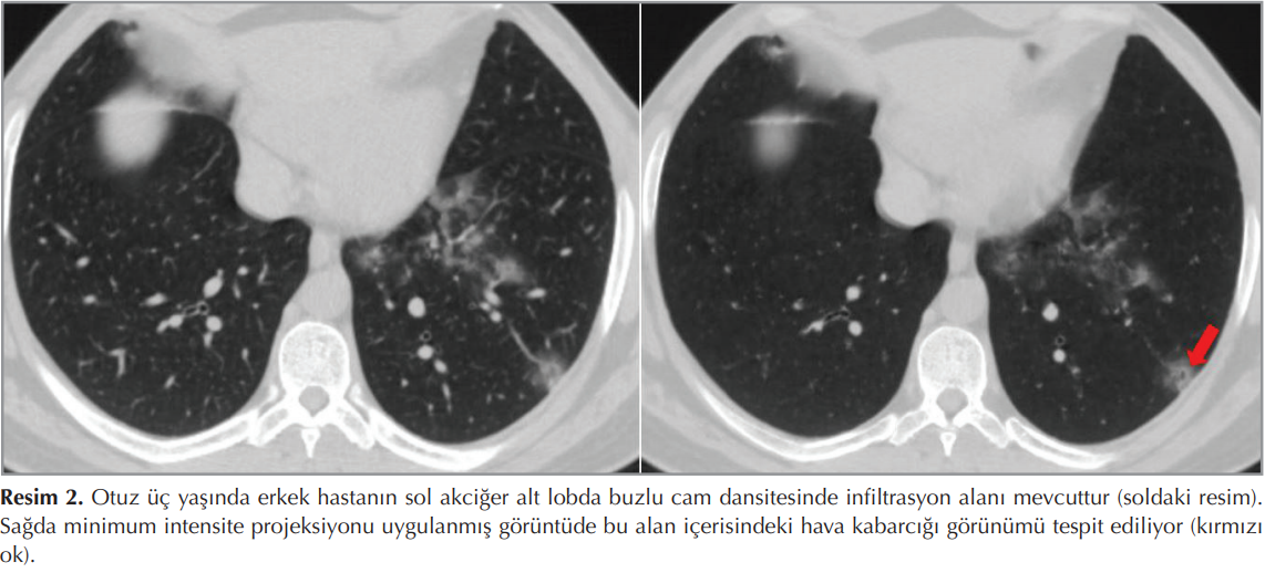Akciğer Tüberkülozu Kavitesi